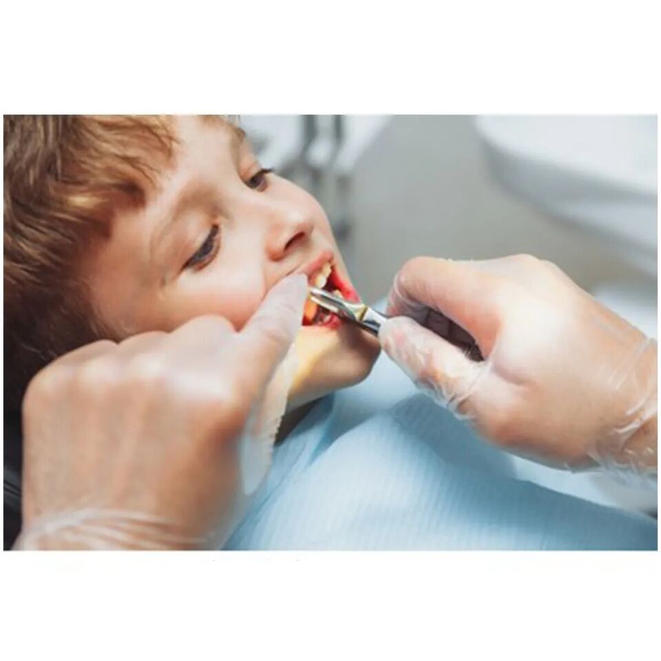 Dental Pediatric Extraction Upper/Lower Molar Root Forceps Set For chi